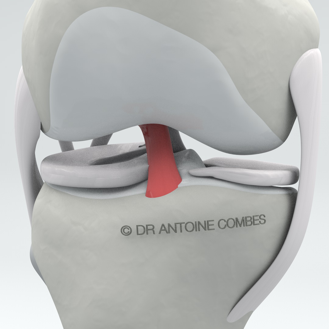 Reconstruction du Ligament Croisé Antérieur - LCA - DR ANTOINE COMBES