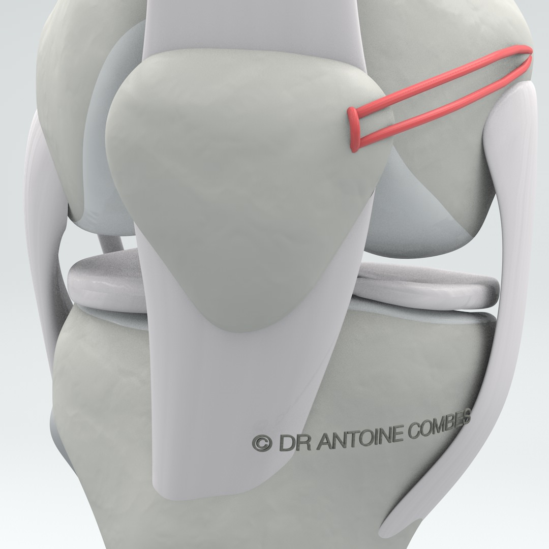 Chirurgies Stabilisatrices de la Rotule - DR ANTOINE COMBES