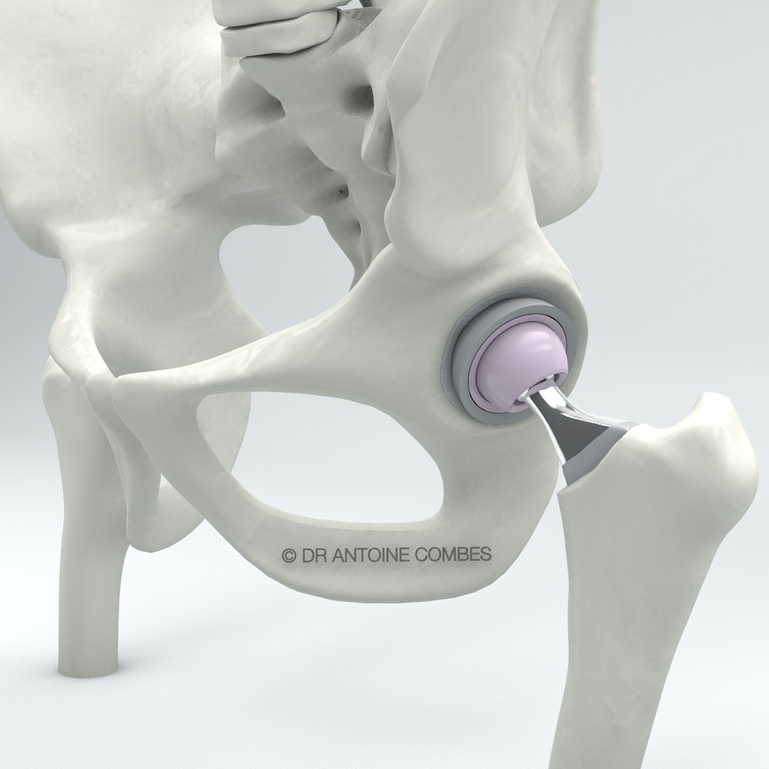 Prothèse Totale de Hanche - PTH - DR ANTOINE COMBES